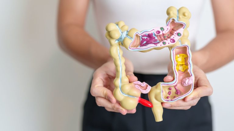 Colitis nerviosa | Síntomas y tratamiento | 2024