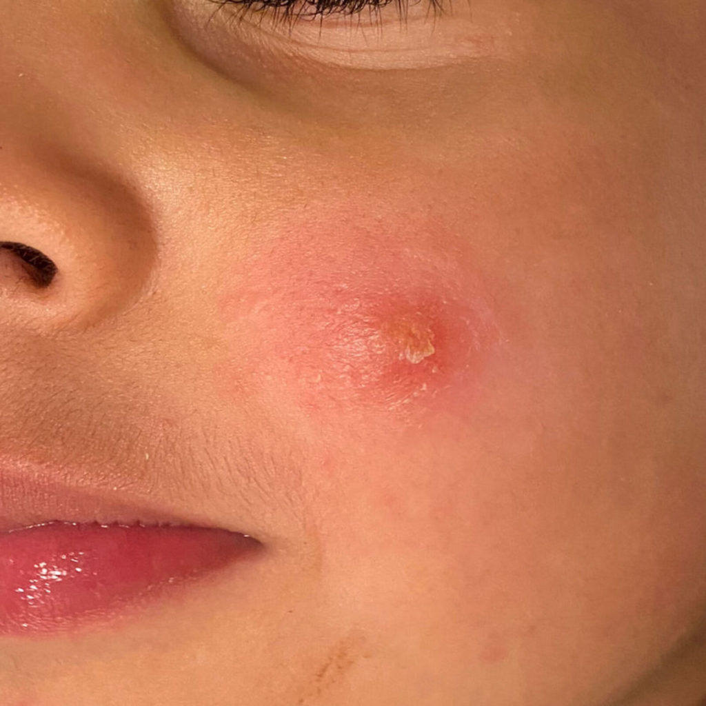 Leishmaniasis cutánea suma 20 casos en Quintana Roo